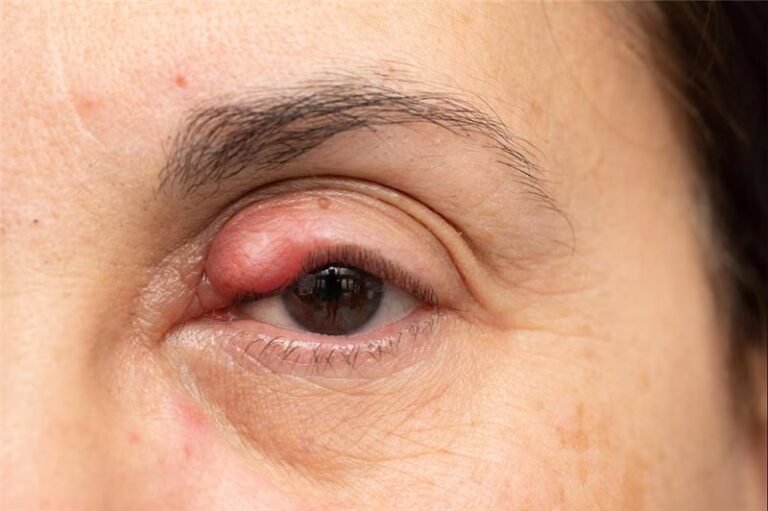 Styes & Chalazion: Why Sweat and Oil Buildup Cause Eyelid Infections ...