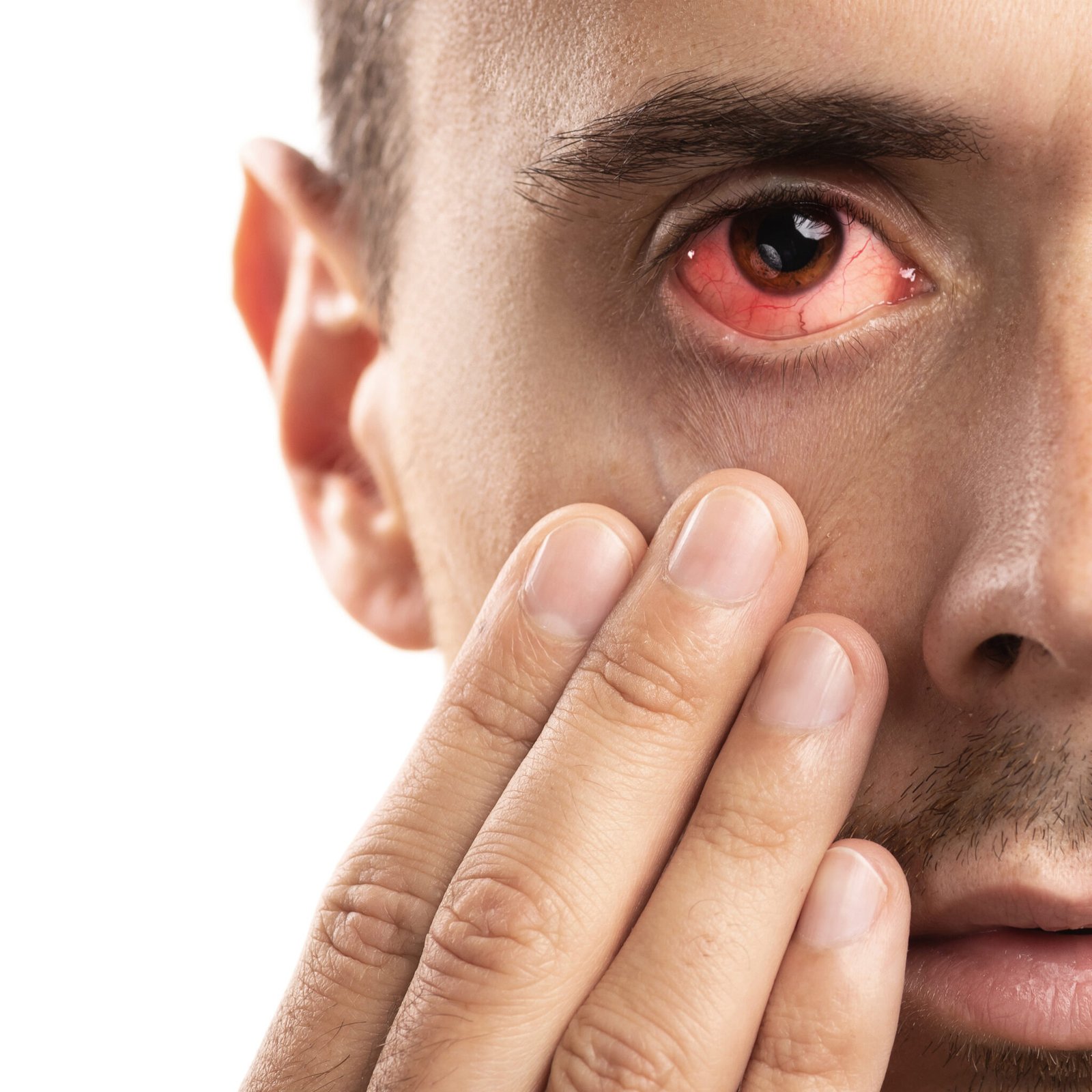 Red Eye in Rainy Season: Viral or Allergic Causes